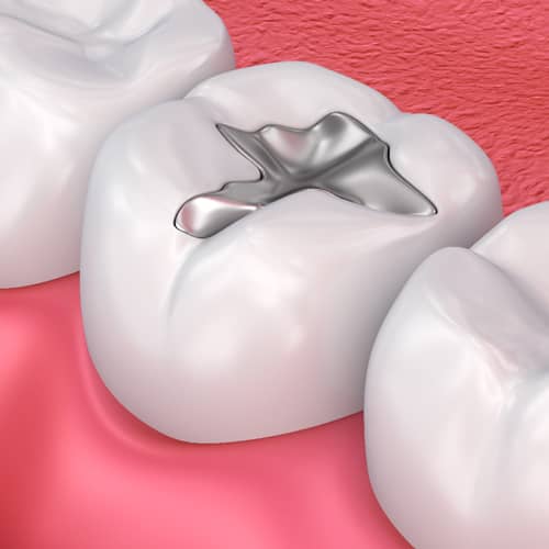 Dental Fillings Chelmsford | White Fillings | Dentist Essex